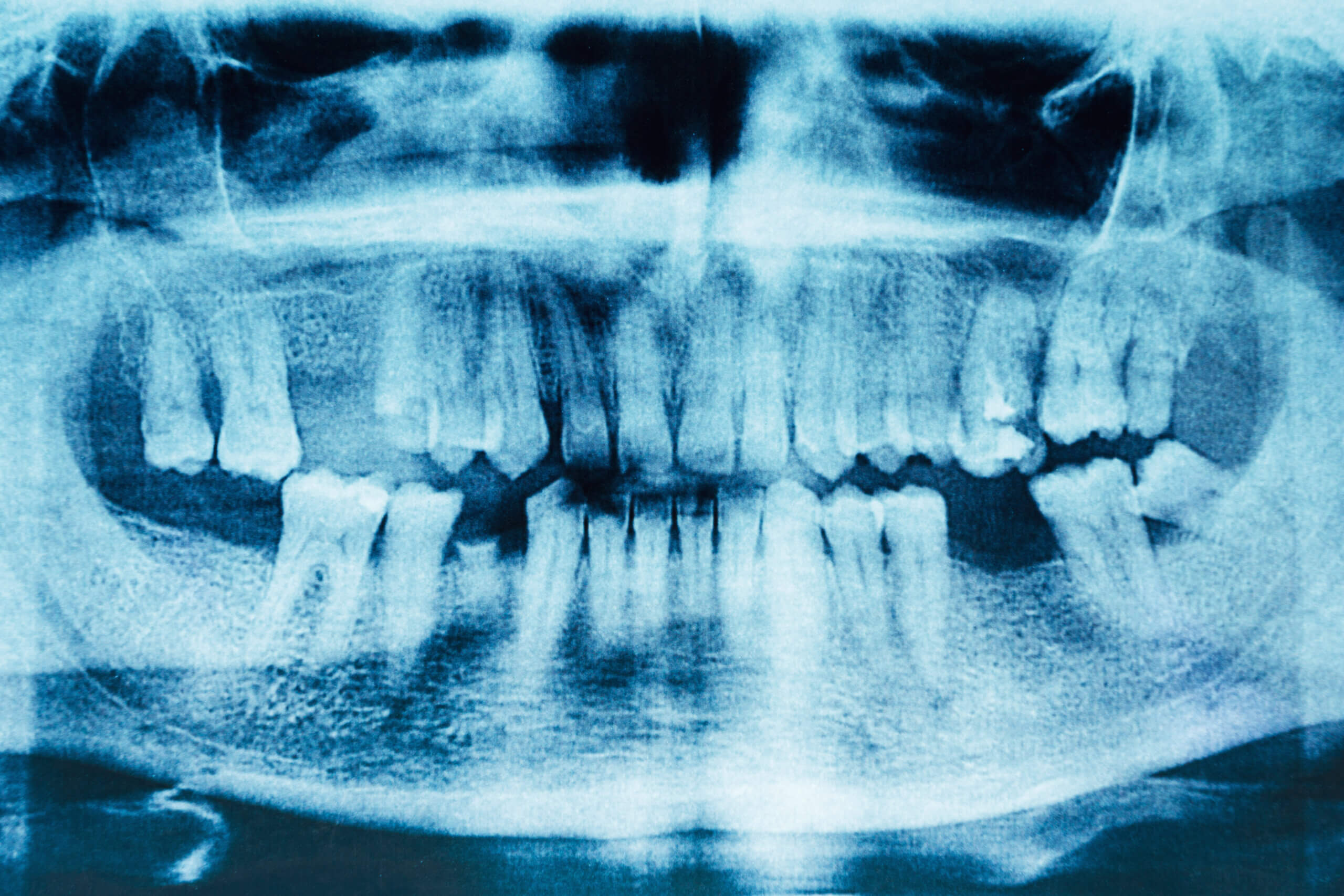 How Missing Teeth Can Affect Your Jawbone/Face and Smile - Vero Elite ...